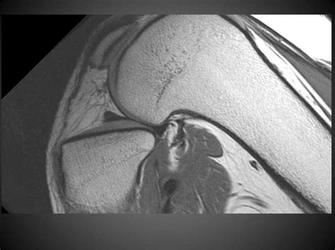 Mri Pd Sagittal Plane Healthy Knee Mri Exam In Full Flexion