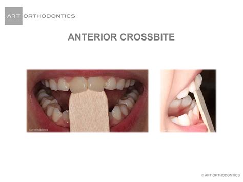 Crossbite Correction