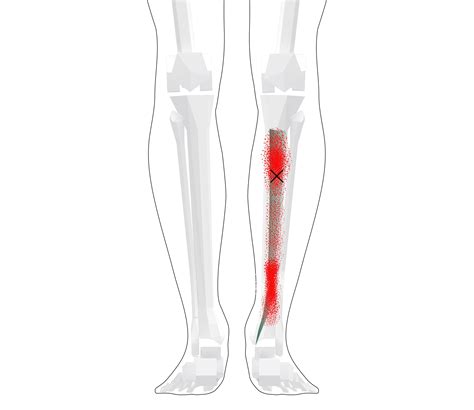 Posterior Knee Leg Trigger Points Overview Tips Exercises
