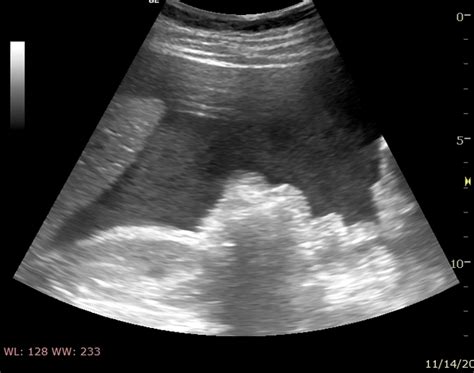 Ruptured Ectopic Pregnancy Ultrasound