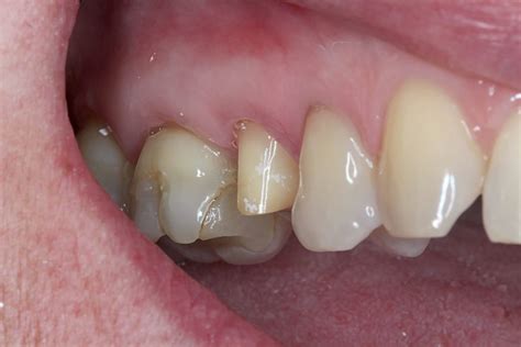 Kronen Und Br Cken Dentallabor Siefker