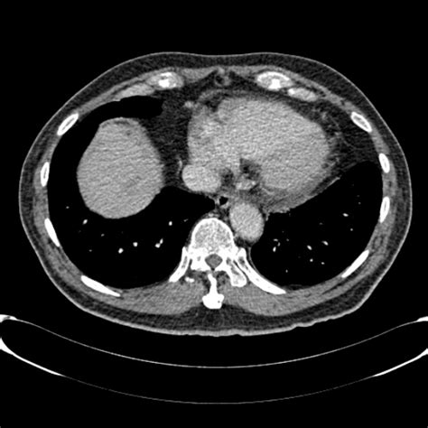 Cholangiocarcinoma Radiopaedia 49009 54379 A Nc Commons