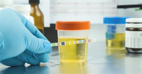 Weak Urine Stream Explained Causes Symptoms And Treatment