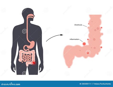 Diverticulitis And Diverticulosis Stock Vector Illustration Of Disease Diverticulosis 285500111