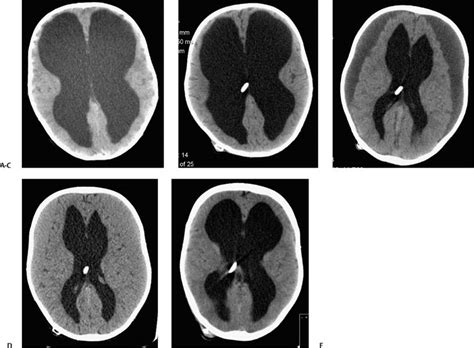 Communicating Hydrocephalus Neupsy Key