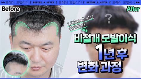 M자 탈모 모발이식 1200모낭 1년 변화 과정ㅣ포헤어 부산 Youtube