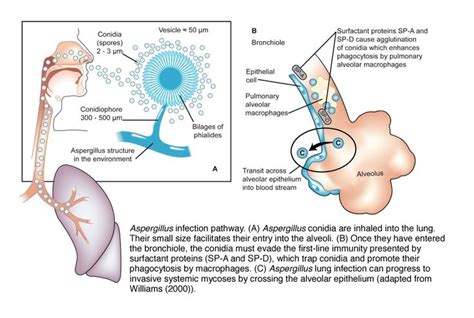 17 Best Images About Aspergillosis On Pinterest Cases Lungs And Therapy