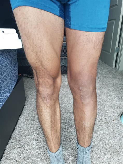 Cirurgia De Ligamento Cruzado Anterior Lca Instituto Vrogue Co