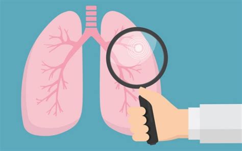 Southcoast Health Lung Cancer Screening Event Promotes Early Detection