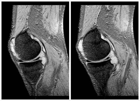 Synovial Chondromatosis Masquerading As A Para Meniscal Cyst Of The
