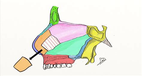 Submucous Resection Of The Deviated Septal Cartilage With Preservation Download Scientific