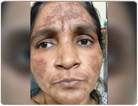 Kolors Hair And Skin Pigmentation Images