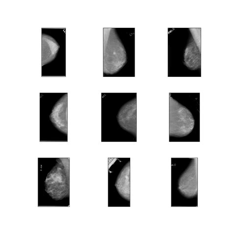 Curated Breast Imaging Ddsm TensorFlow Datasets