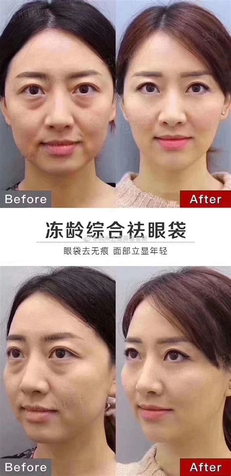 去眼袋手术案例对比 眼袋足足显老十岁 内路无痕祛眼袋 损伤小，肿胀不明显，无须缝合⚡ 杭州艺星2020，带美丽回家 花瓣网