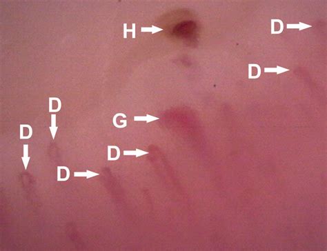 Scleroderma Type Capillaroscopic Pattern An Early Phase D Dilated Download Scientific
