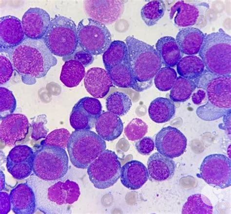 Acute Erythroid Leukemia Aml M6