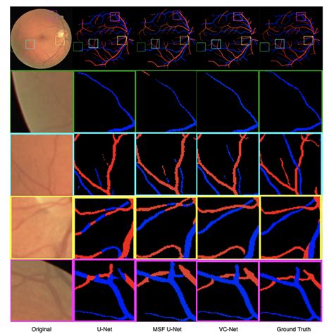 Figure 1 From Automatic Arteryvein Classification Using A Vessel Constraint Network For