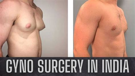 Watch This Video Before Getting A Gynecomastia Surgery In India Youtube
