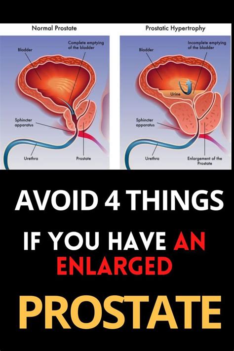 Prostate Health The Importance Of Early Detection Artofit