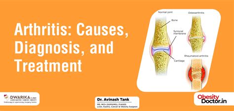 Arthritis Causes Diagnosis And Treatment Dr Avinashtank Is A