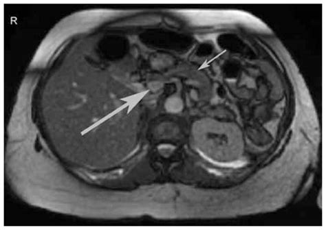 Successful Treatment Of Persistent Hyperinsulinemic Hypoglycemia With