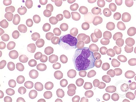 Variant Lymphocytes 1