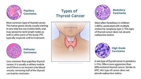 Types Of Thyroid Cancer MEDizzy