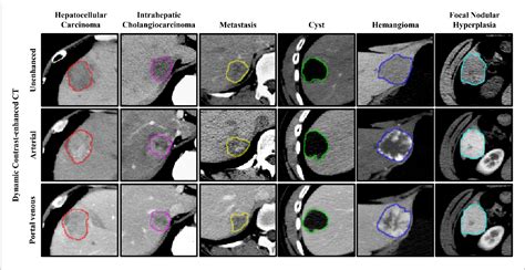 Figure 1 From Automatic Detection And Classification Of Focal Liver