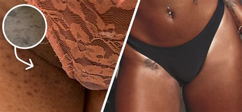 Bikini Line Area Dark