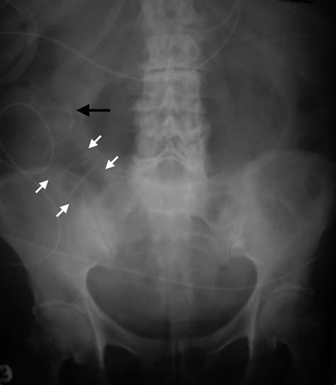 Gallstone Ileus New