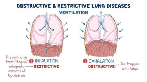 Obstructive Vs Restrictive Pulmonary Disease Video Causes And Meaning