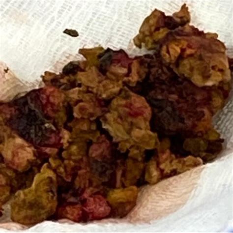 Intraoperative Photo At Initial Liver Operation Download Scientific