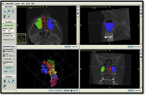 e segmentation procedure using itk snap software download scientific