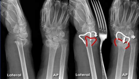 Upper Limb Fractures Flashcards Quizlet