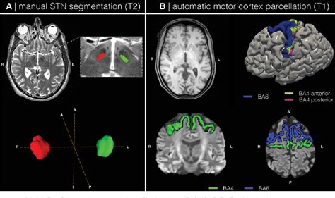 Figure From Probabilistic Versus Deterministic Tractography For