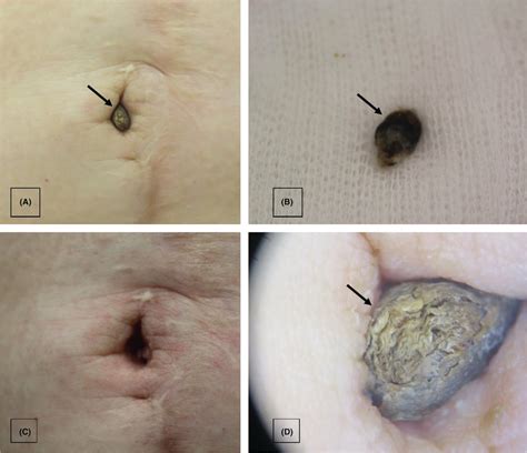 A Keratotic Brownish Nodule Protruding Out Of The Umbilicus Black