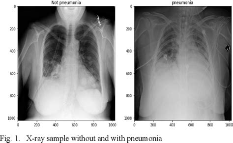 Figure 1 From Automated Detection Of Pneumonia Using Pre Trained Convolutional Neural Networks