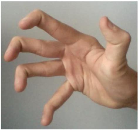 Hyper Flexibility At Right Hand Permission Obtained From The Patient