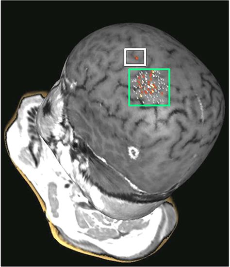 Preoperative Navigated Transcranial Magnetic Stimulation Ntms White Download Scientific
