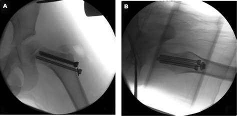 Three Cannulated Compression Screws Were Inserted Along The Guide Pins