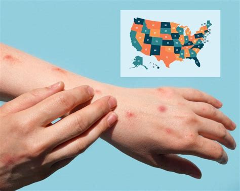 Us Now Has A Third Of The Worlds Monkeypox Cases