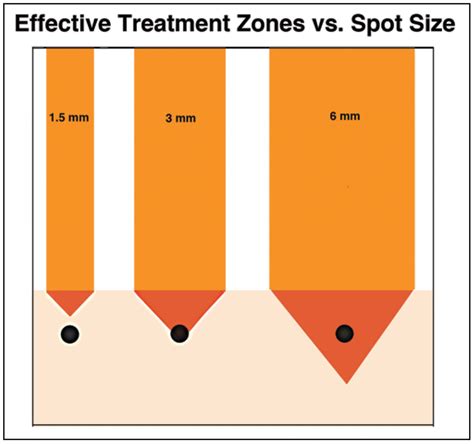 Size Matters How Spot Size Affects Your Tattoo Removal