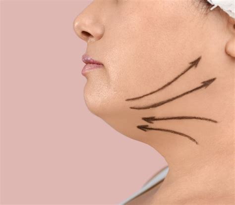 Double Chin Treatments In Langley Bc Eve Therapy