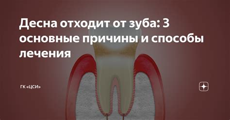 Десна отходит от зуба: 3 основные причины и способы лечения | ГК «ЦСИ ...