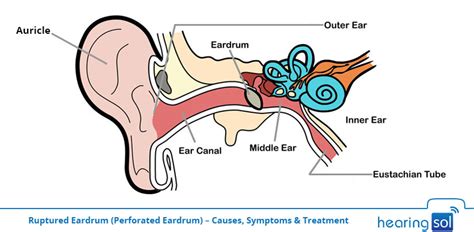 Broken Eardrums Symptoms Rupture Of Eardrum Symptoms Xfwkz