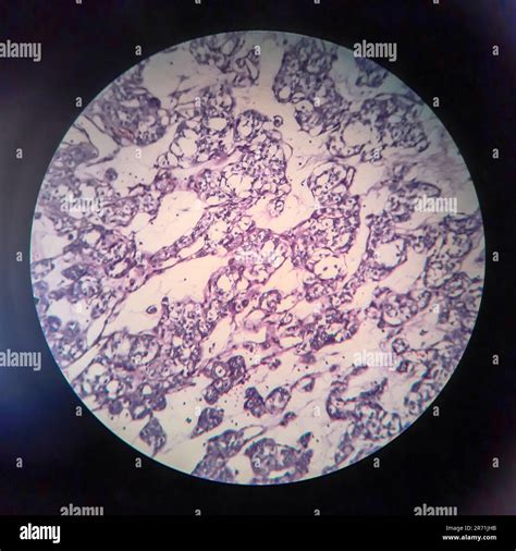 Thyroid Follicular Carcinoma Light Micrograph Photo Under Microscope