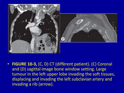 The Chest Wall Pleura Diaphragm And Intervention 10 Dr Muhammad Bin