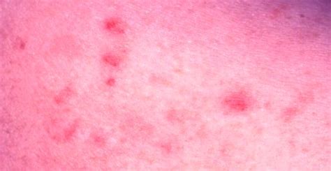 Maculopapular Rash Causes Treatment And Pictures Worl