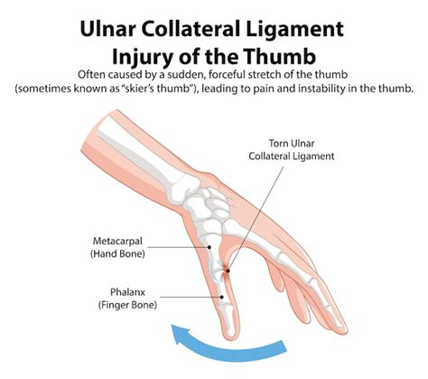 Lésion Du Ligament Collatéral Ulnar Du Pouce Vecteur Gratuite