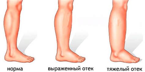 Лимфостаз и его рецепты